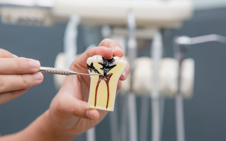 Endodoncia – Clinica Acacia